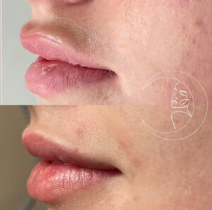 Before and After Images of Clients at True Medical Aesthetics